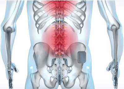 Neurostimulation Therapy is a Game-Changer in the Treatment of Back ...