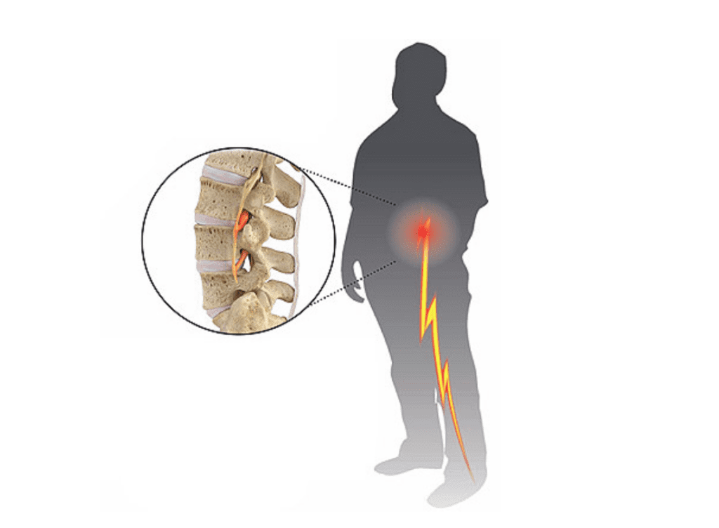 Sufferers of LSS Find Immediate Pain Relief with Life-Changing ...